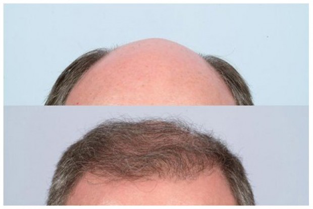 Images of hair transplant surgery results for a bald scalp