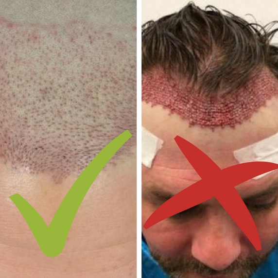 Hair Transplant Clinic Uk Hair Replacement Surgery Hrbr