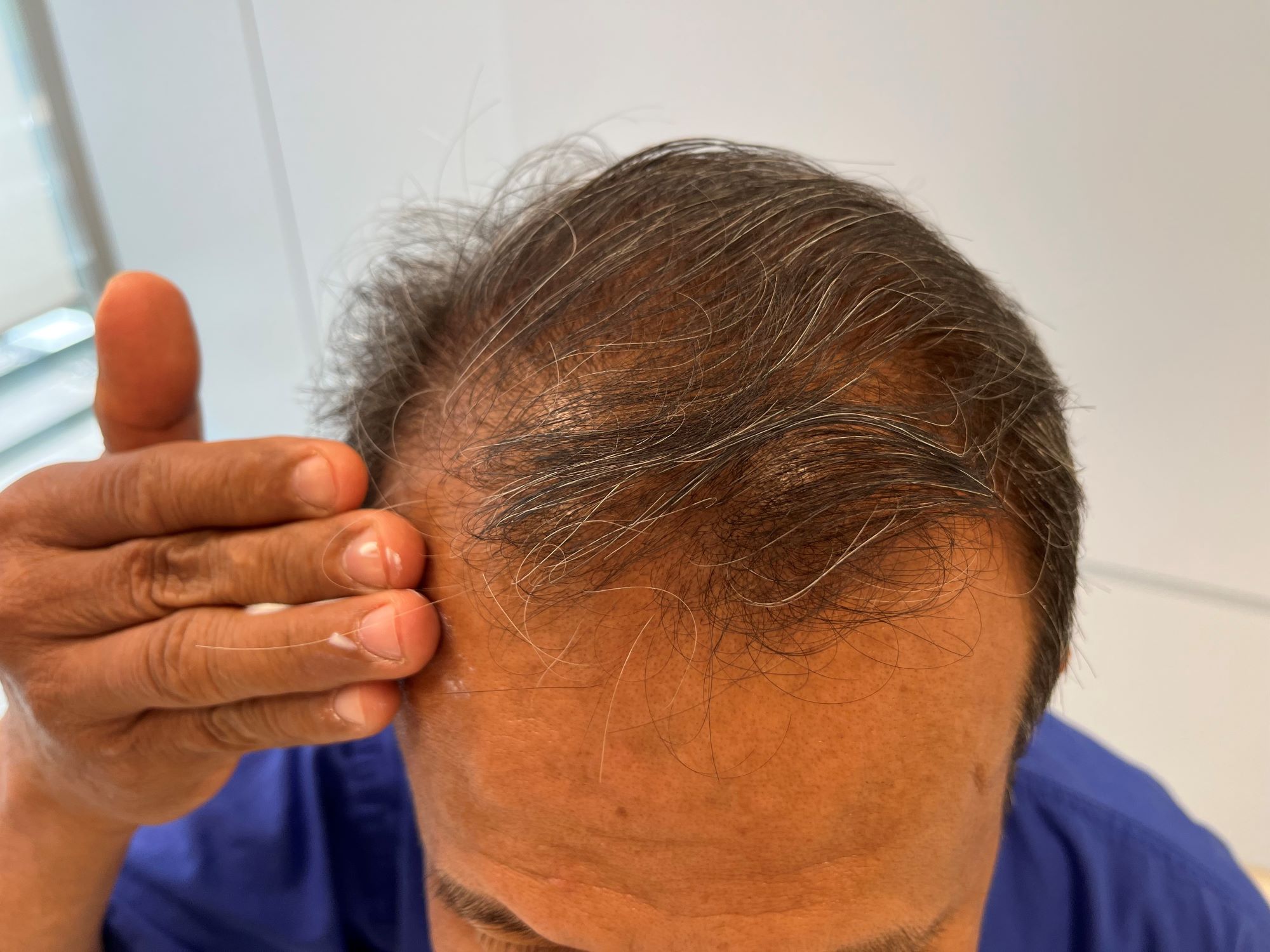 Those with Male Pattern Hair Loss at Higher Risk of Skin Cancer - HRBR