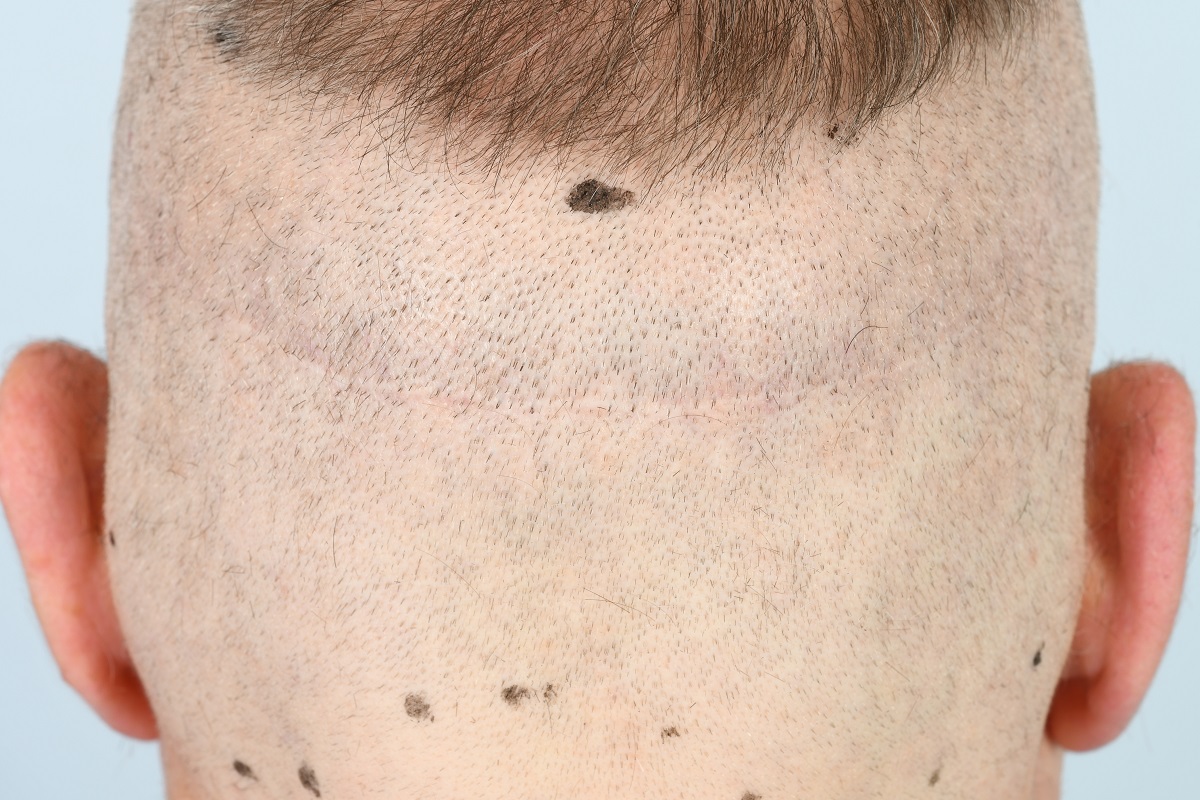 Maximising a Patients Donor Hair for Transplantation - HRBR